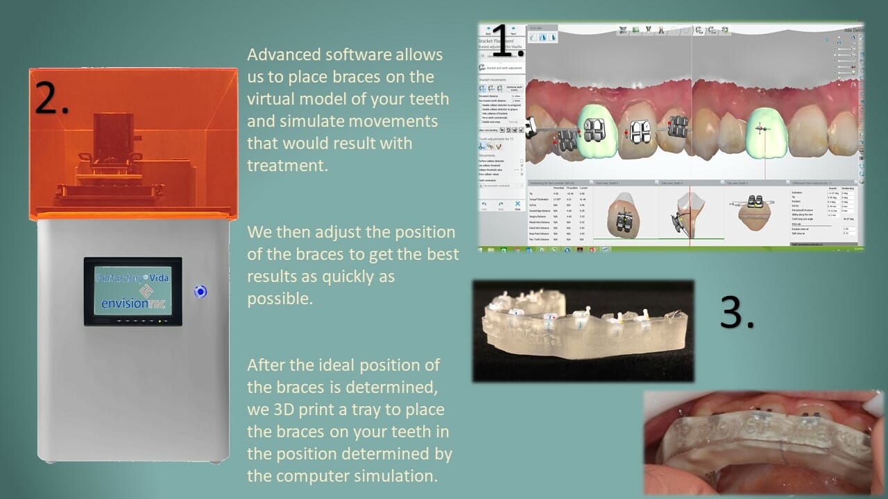 Digital process we use to put on braces - Salaita Orthodontics